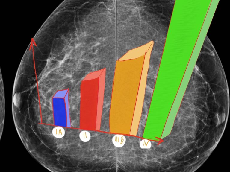 Breast Cancer Stages - Explained - Pro doctor Breast Cancer Stages - Explained - Pro doctor